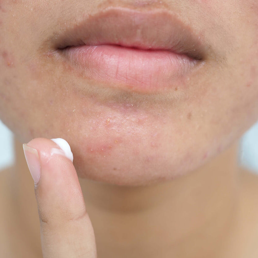 Dr. Pimple Popper's Guide to Starting Acne Treatment – SLMD Skincare by ...