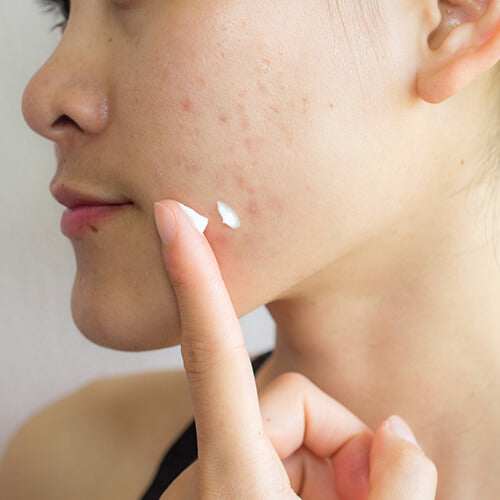 OTC vs. Prescription Benzoyl Peroxide: Which One is Best for Acne ...