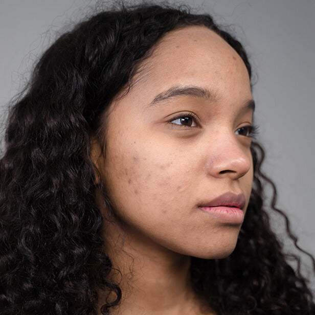 Skin Purging vs. Breaking Out: How to Tell the Difference – SLMD ...