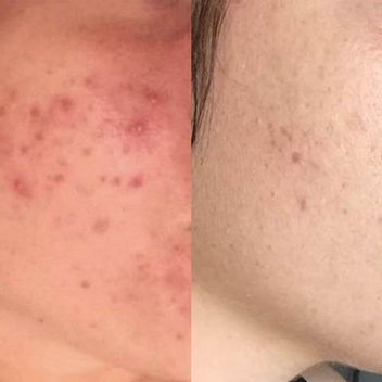 The Ultimate Guide to Treating Post-Inflammatory Hyperpigmentation ...