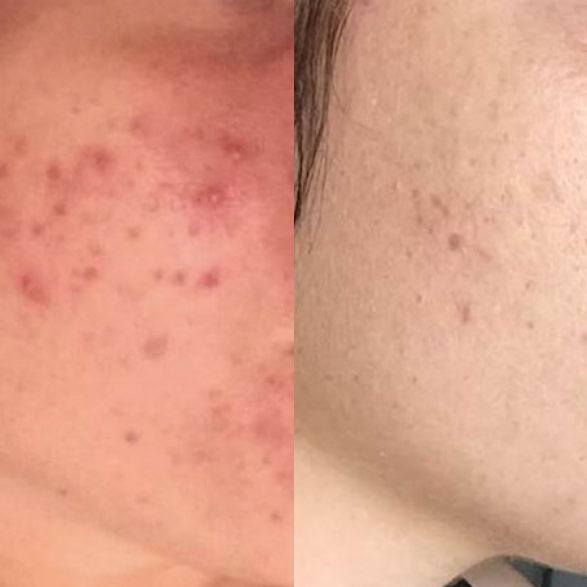 The Ultimate Guide to Treating Post-Inflammatory Hyperpigmentation ...