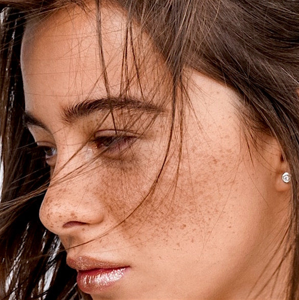 Freckles vs. Sun Damage: Understanding the Differences – SLMD Skincare ...